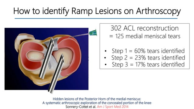 Ramp lesions in the ACL-Injured Knee | PPTX