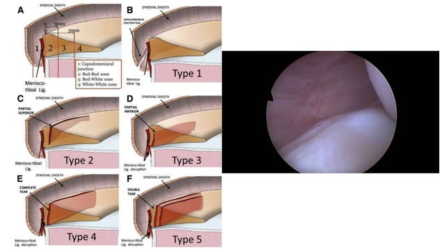 Ramp lesions in the ACL-Injured Knee | PPTX