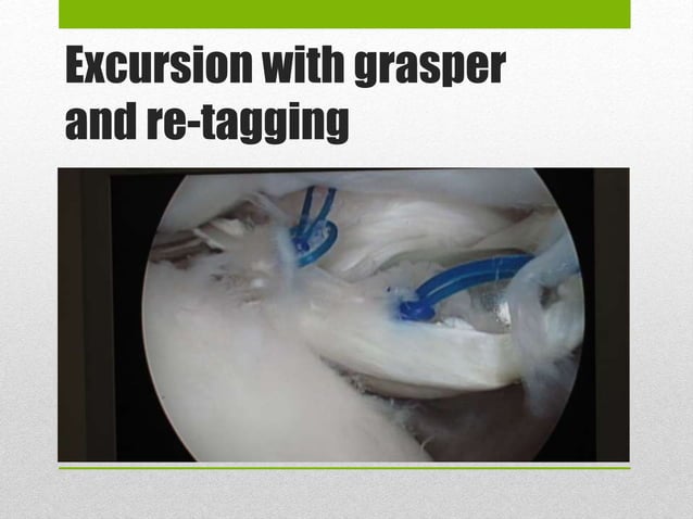 Shoulder arthroscopy does not adequately visualise pathology of the LHB ...
