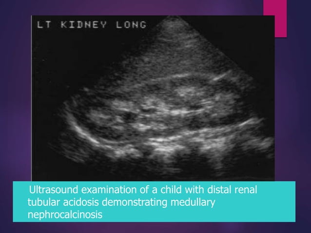 RENAL TUBULAR ACIDOSIS | PPTX | Endocrine and Metabolic Diseases ...