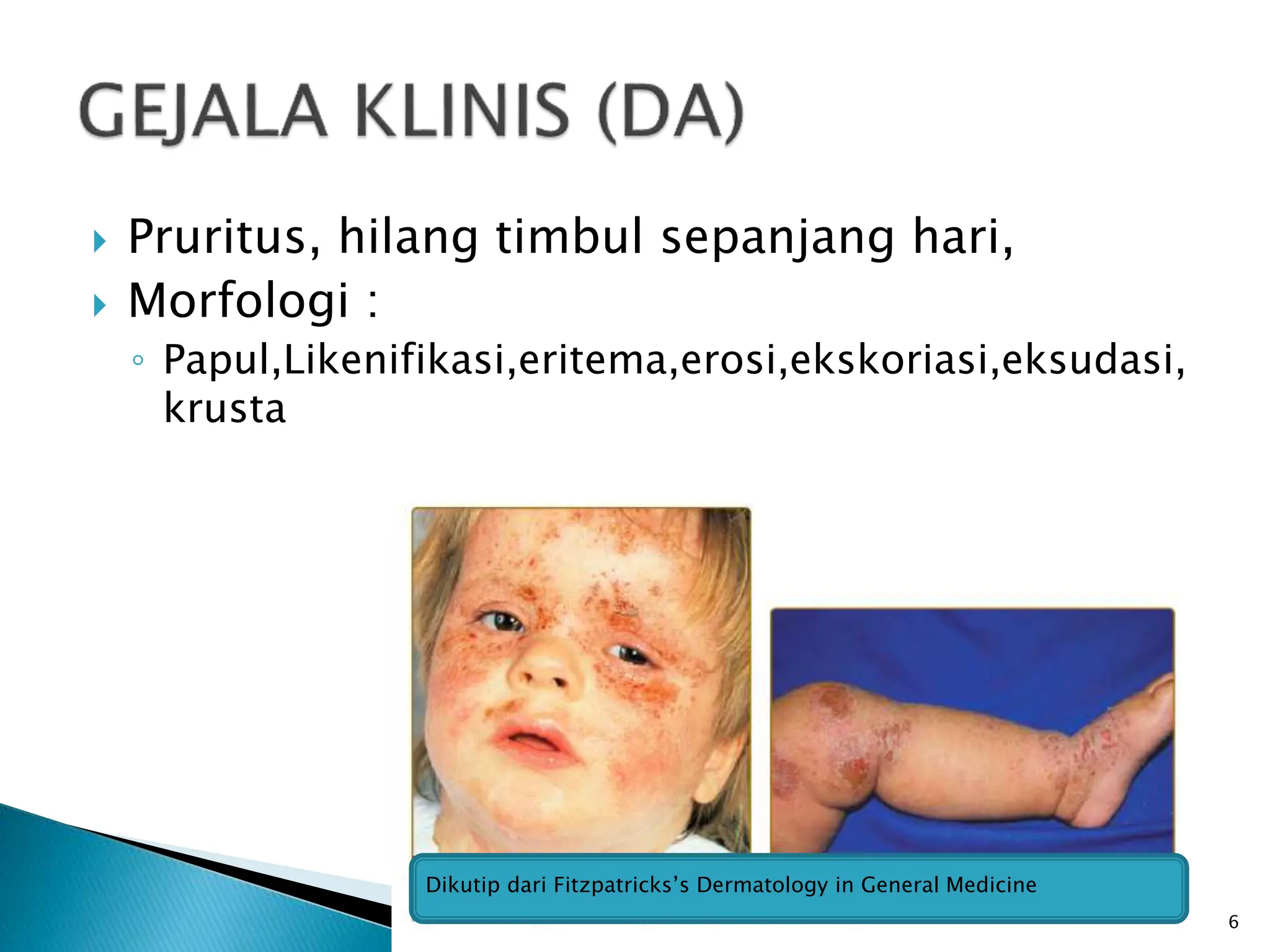Sakit kulit ini membunuhku dermatitis.ppt
