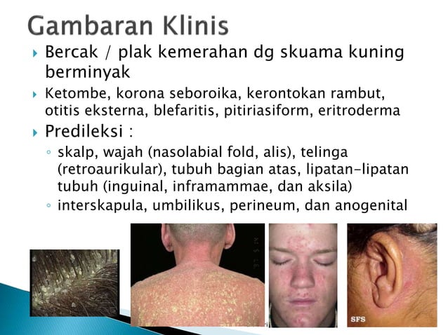 Sakit kulit ini membunuhku dermatitis.ppt