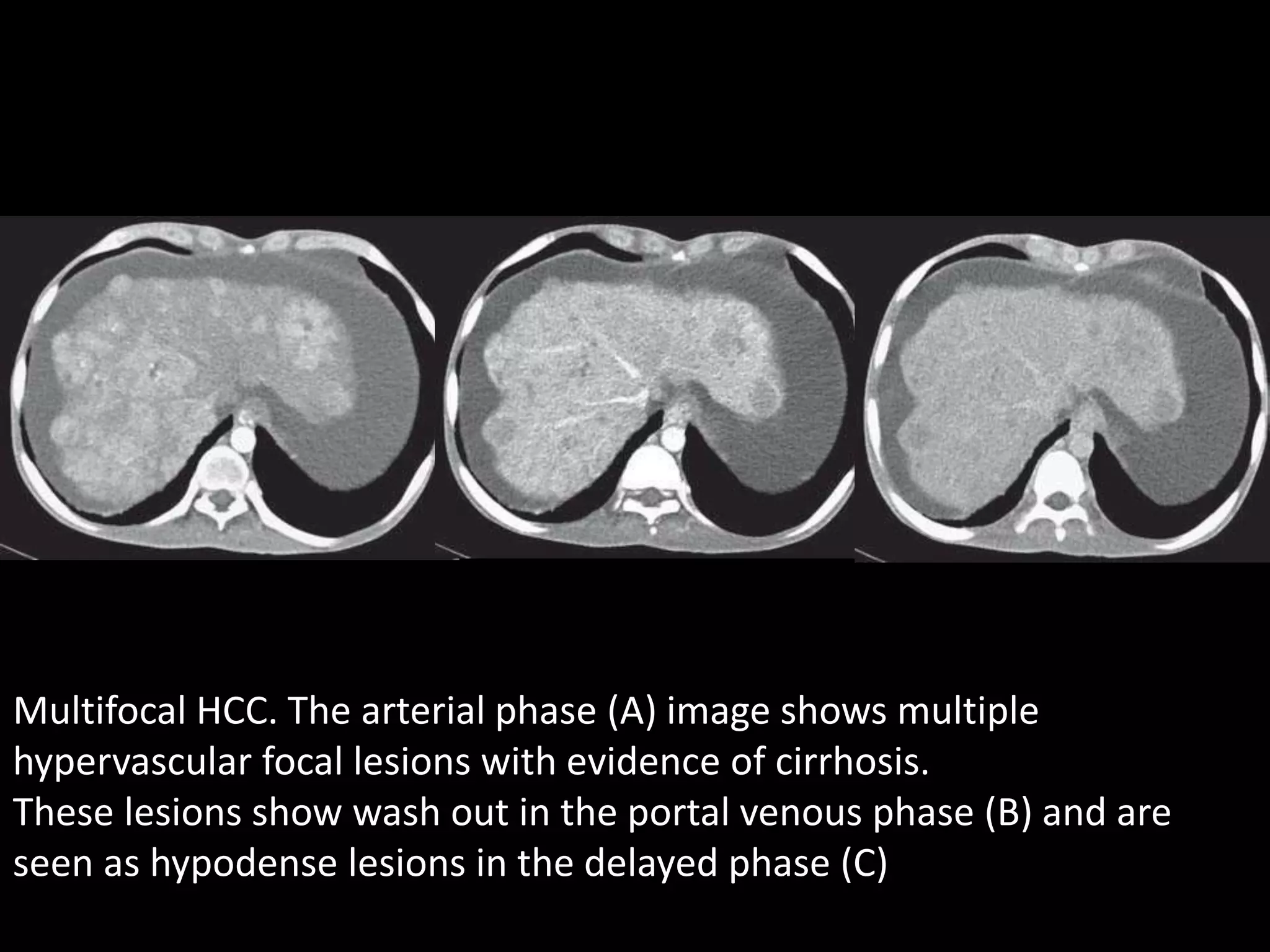 Imaging of Malignant Liver Lesions | PPTX
