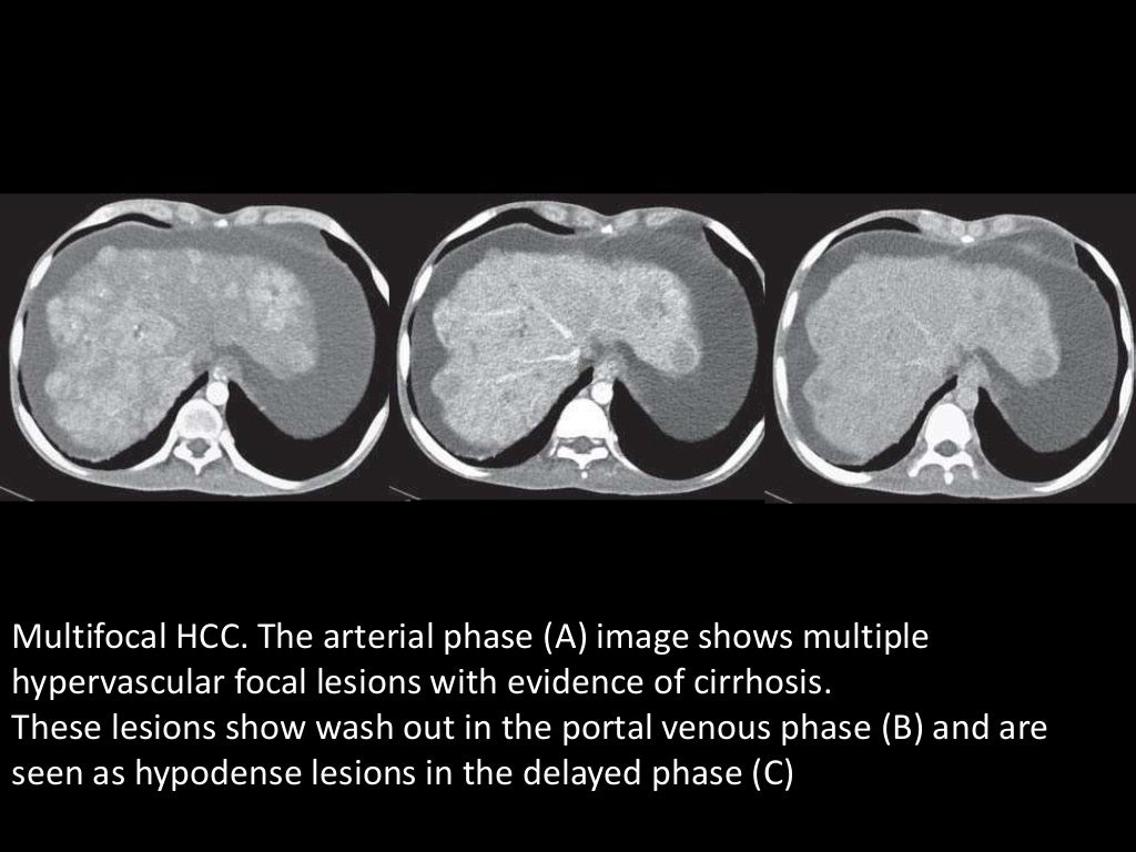 Imaging of Malignant Liver Lesions