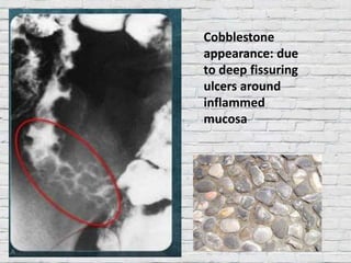 IBD AND ABDOMINAL TB-ROLE OF IMAGING | PPTX