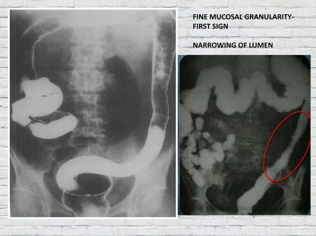IBD AND ABDOMINAL TB-ROLE OF IMAGING | PPT