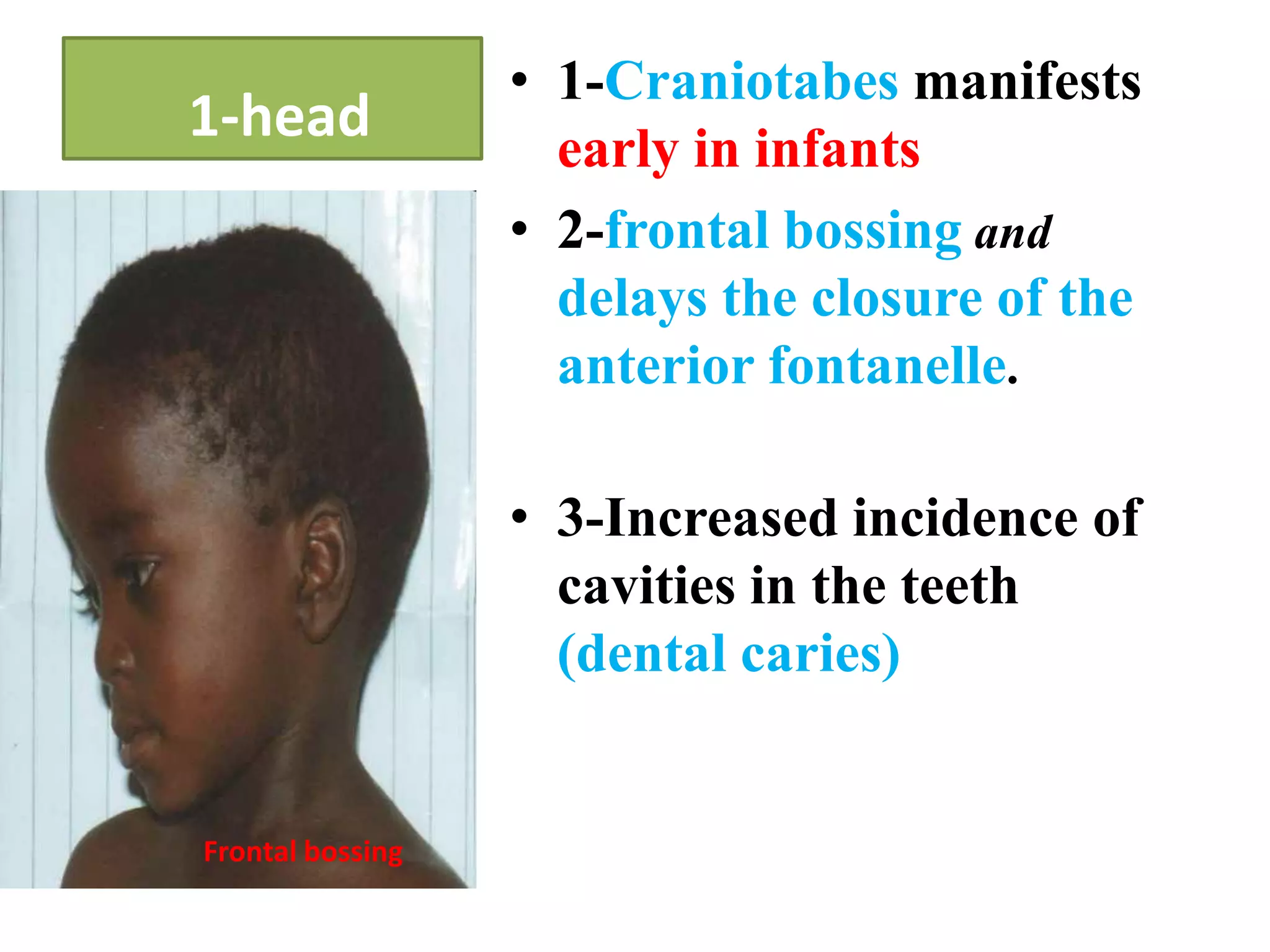 Approach to a child with Rickets | PPTX