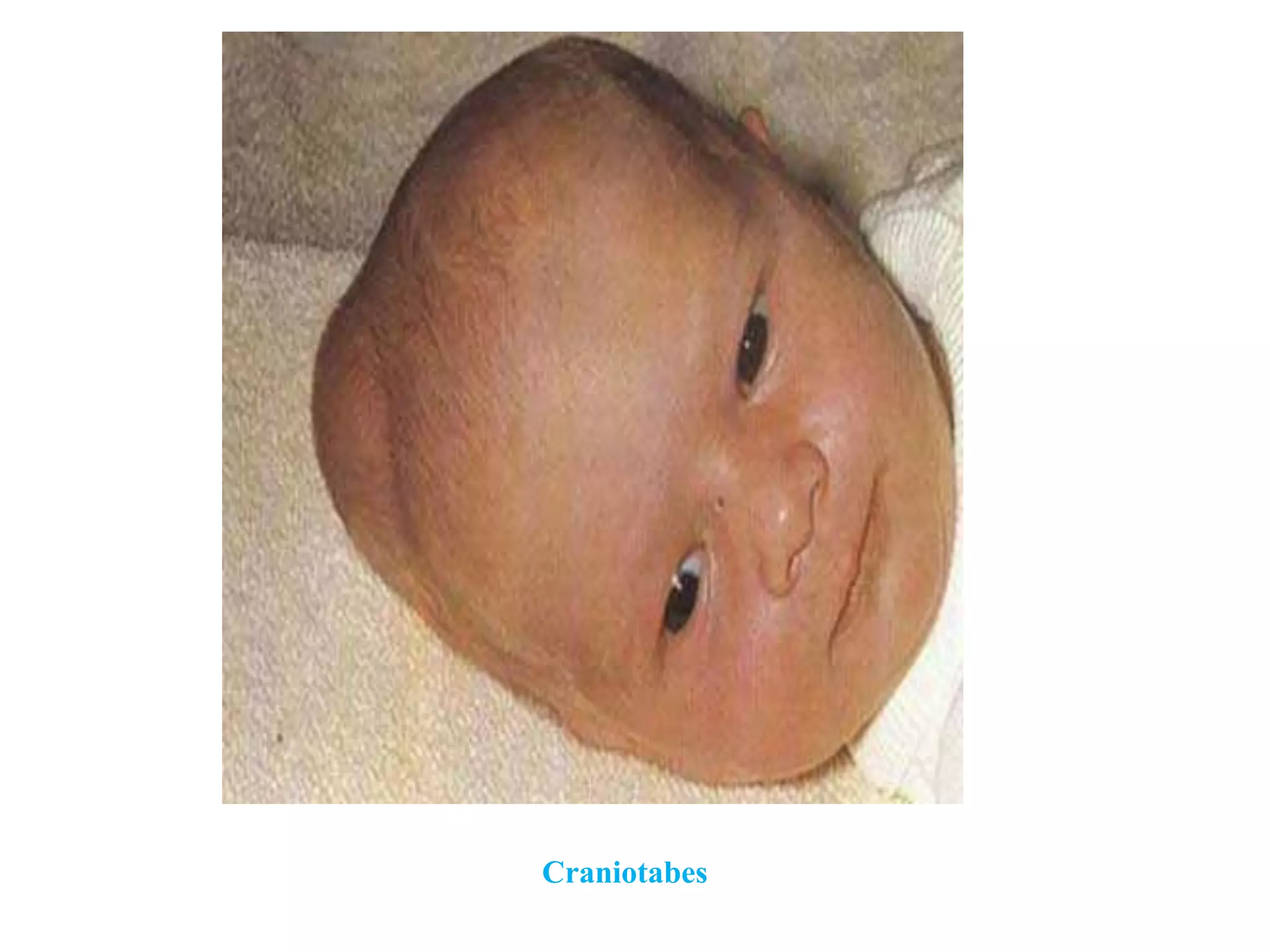 Approach to a child with Rickets | PPTX