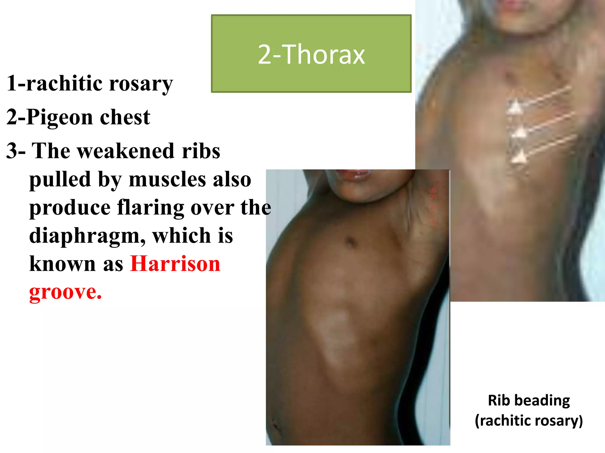 Approach to a child with Rickets | PPTX