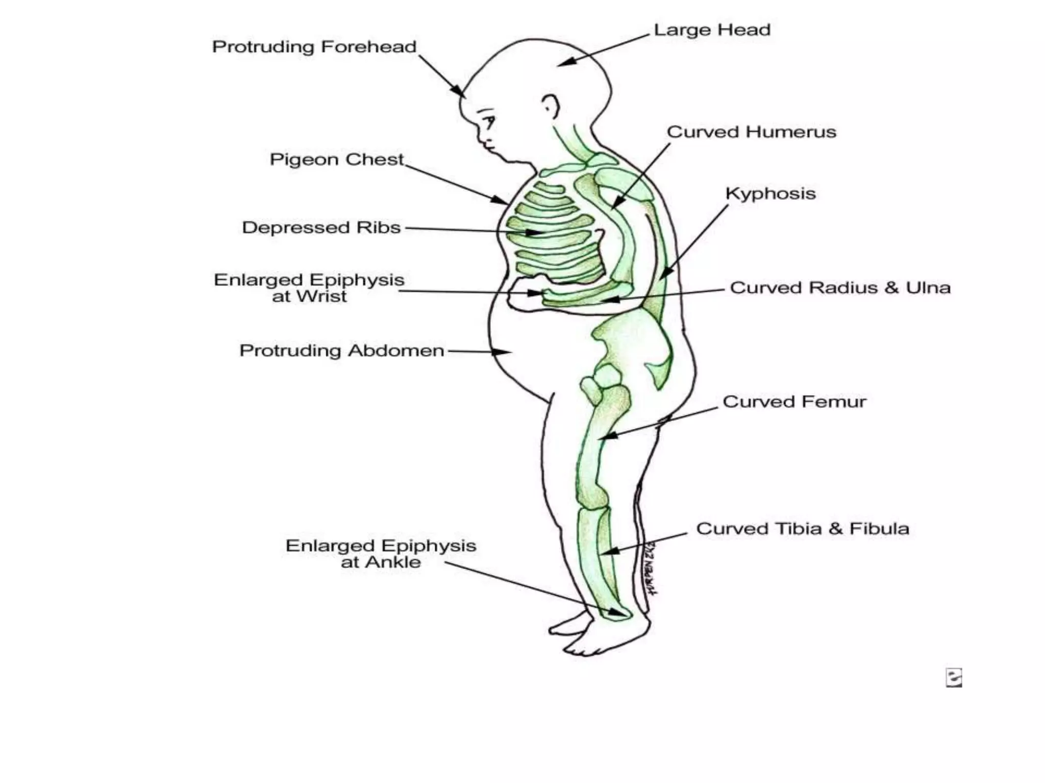 Approach to a child with Rickets | PPTX