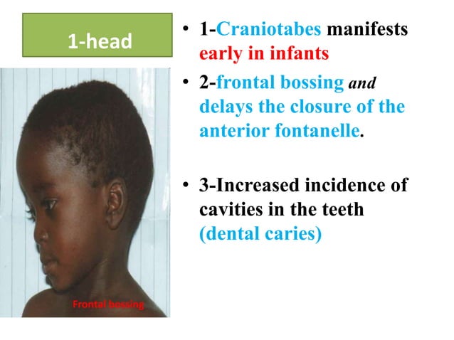 Approach to a child with Rickets | PPTX