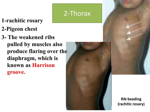 Approach to a child with Rickets | PPTX