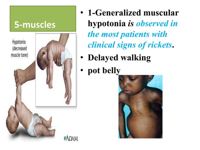 Approach to a child with Rickets | PPTX