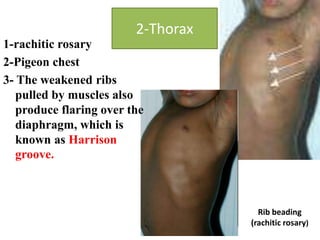 Approach to a child with Rickets | PPT