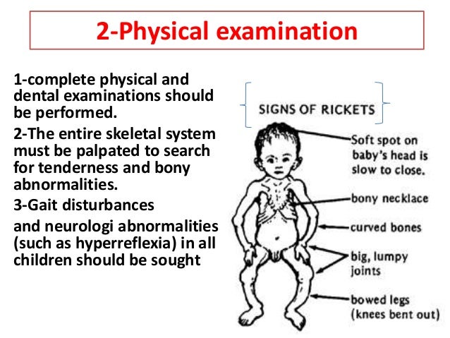 Approach to a child with Rickets