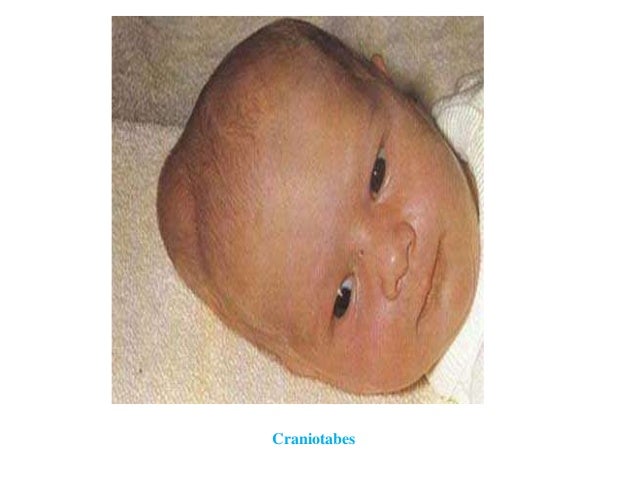 Approach to a child with Rickets