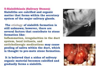 Saliva.gland lect. | PPT | Ear, Nose and Throat Conditions | Diseases ...