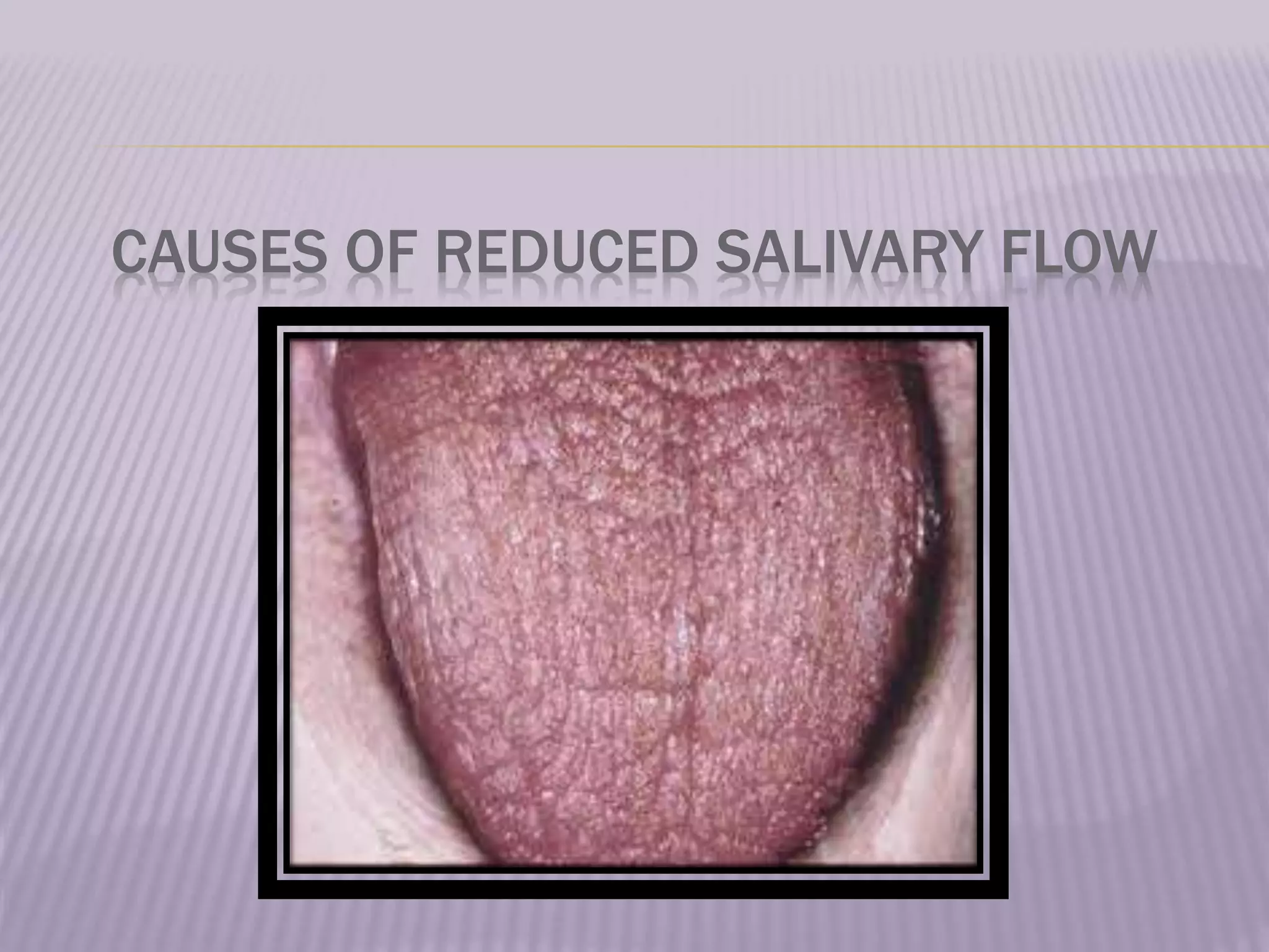 Saliva and caries | PPTX