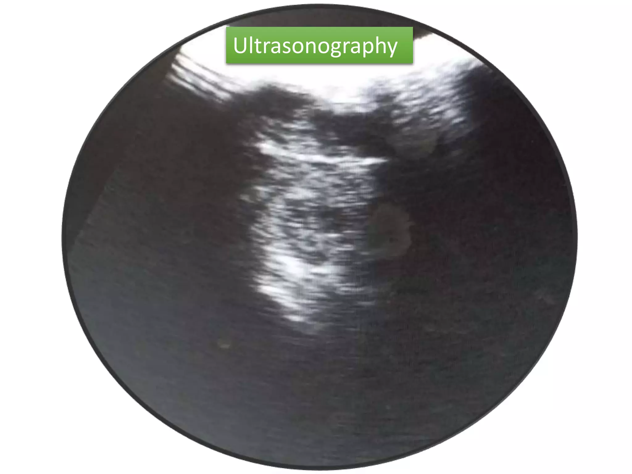 Salivary gland cyst | PPTX