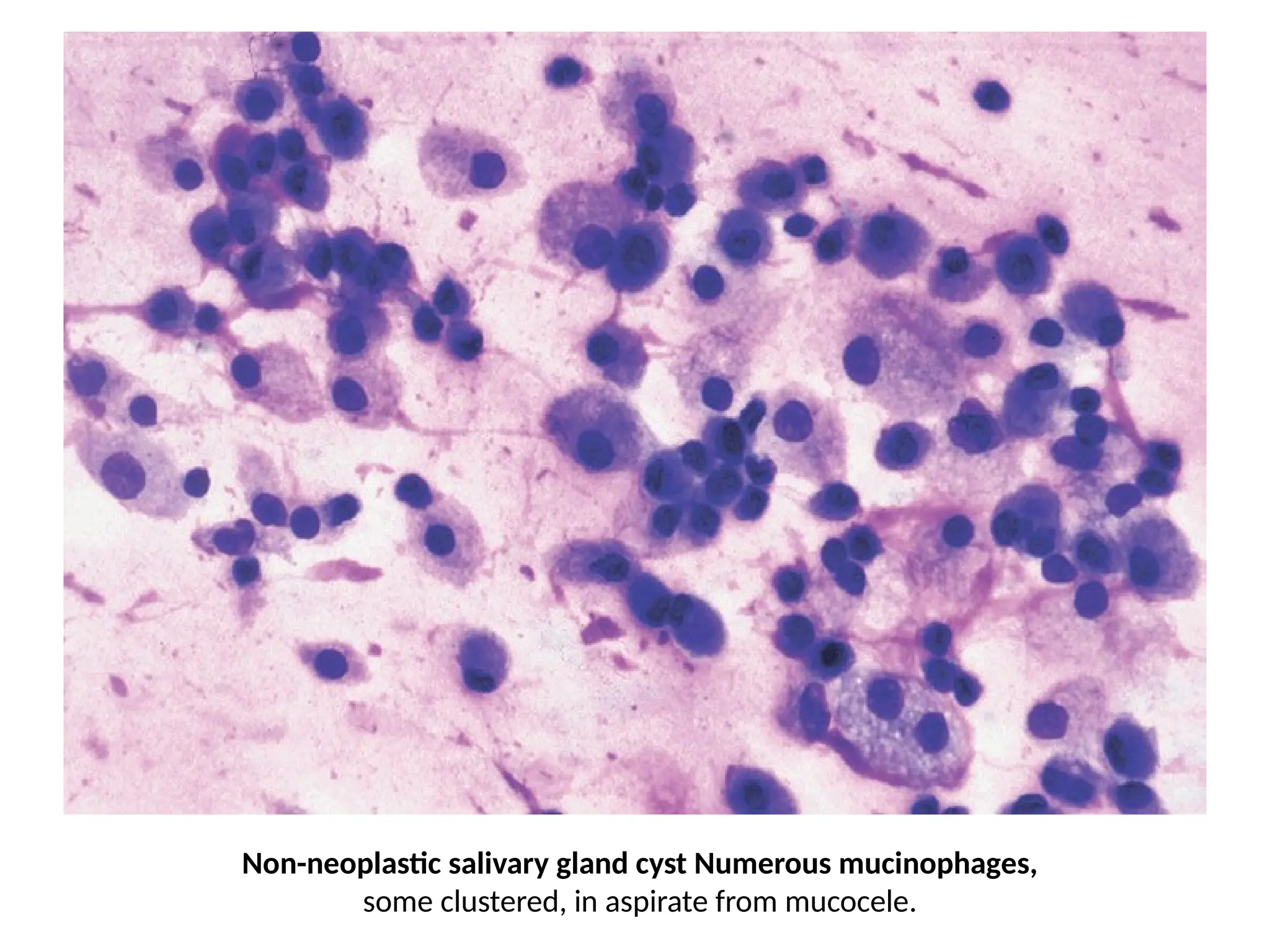 SALIVARY GLAND CYTOPATHOLOGYwith differential diagnosis (1).pptx