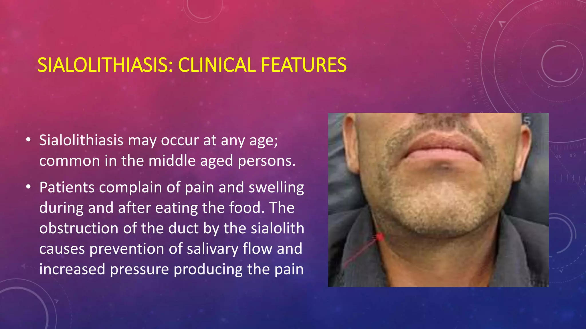 Salivary gland disease | PPTX