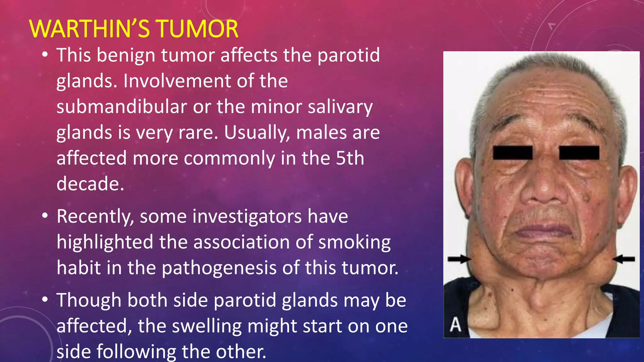 Salivary gland disease | PPTX | Ear, Nose and Throat Conditions | Diseases and Conditions
