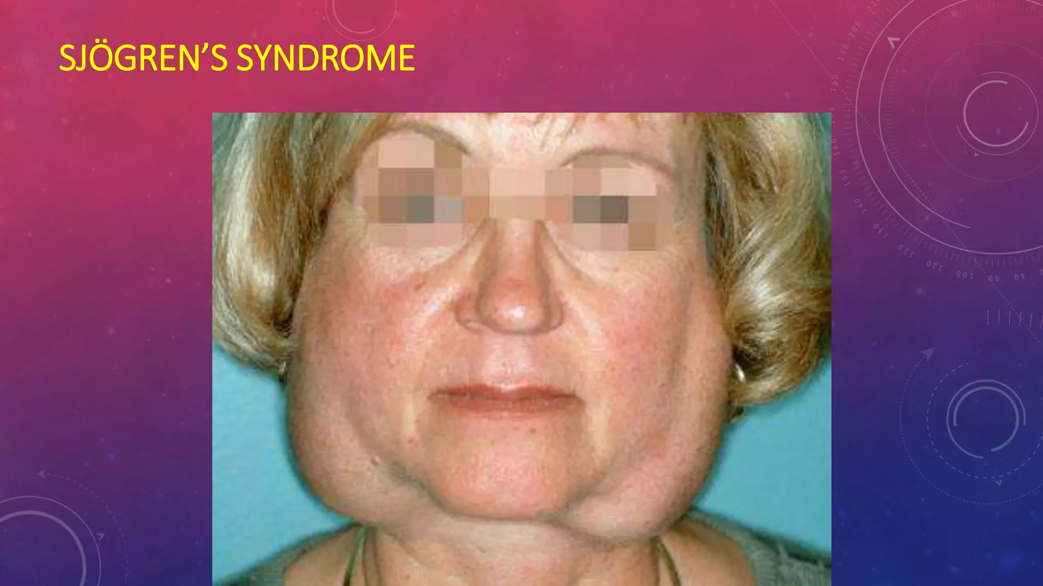 Salivary gland disease | PPTX