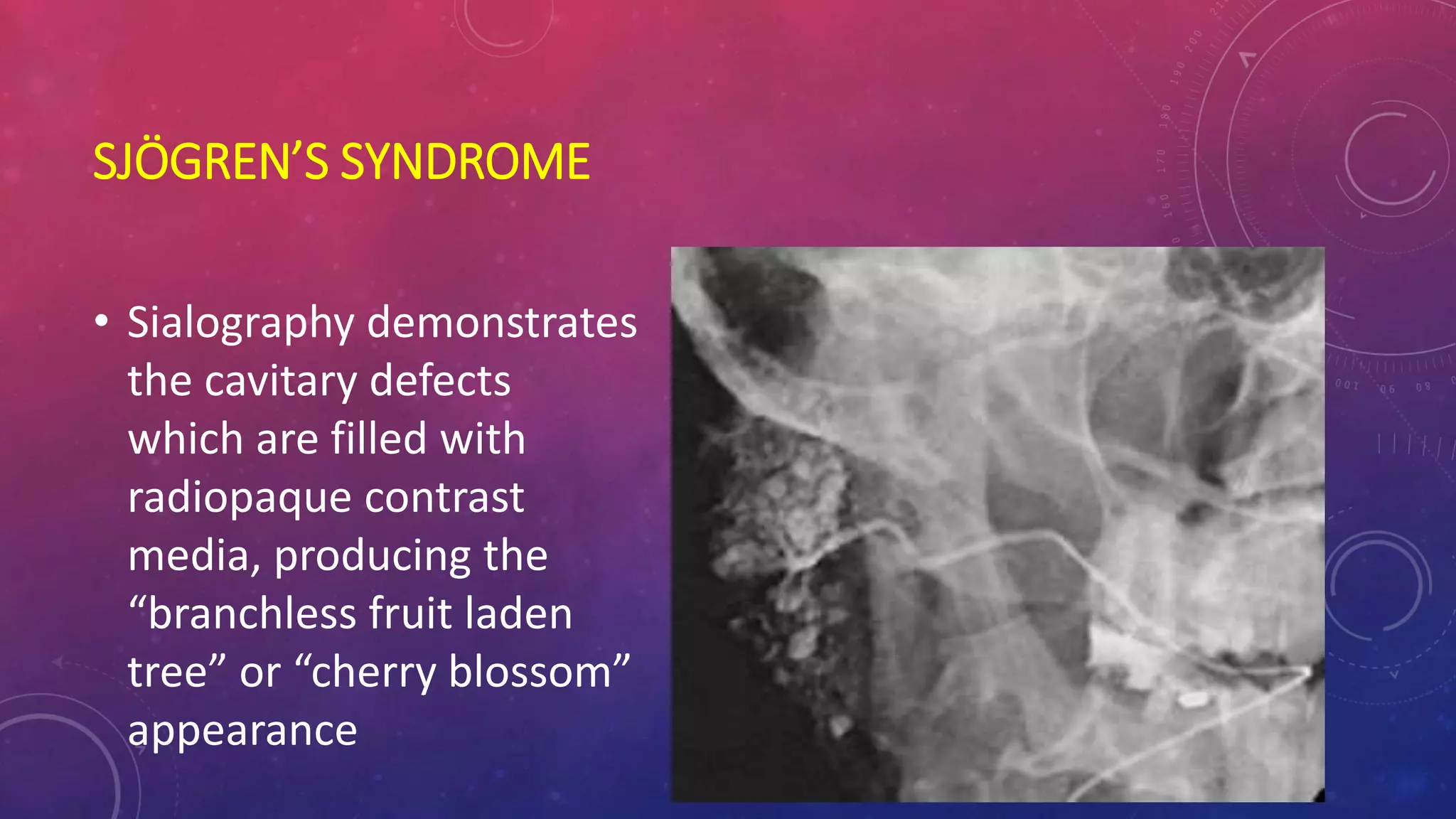 Salivary gland disease | PPTX