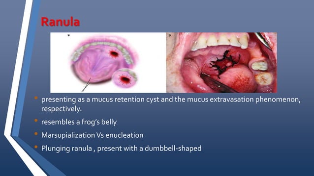 salivary gland disease.pptvt4g6yhg6ygyyy | PPT