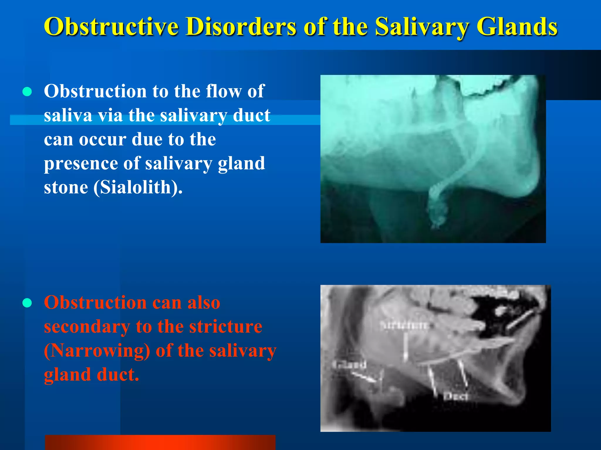 salivary_gland_disease_and_management.ppt