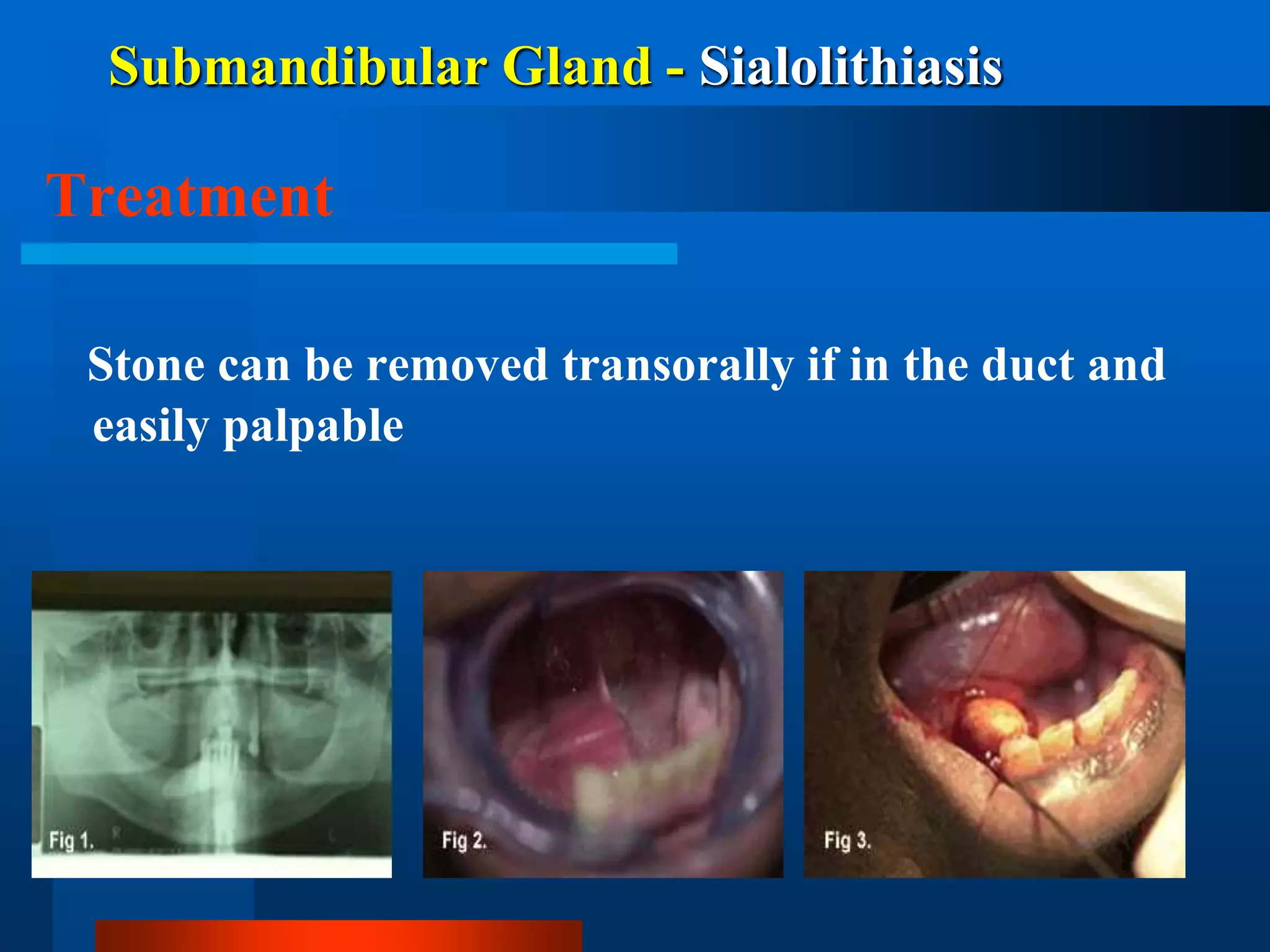 salivary_gland_disease_and_management.ppt