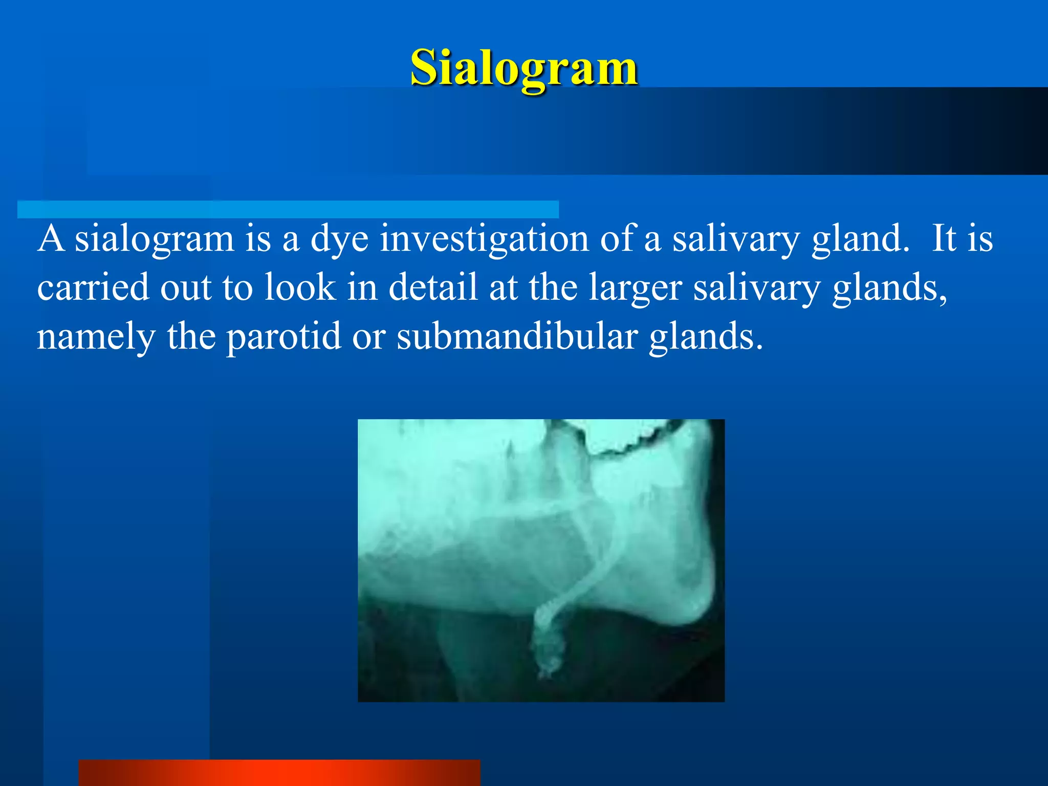salivary_gland_disease_and_management.ppt