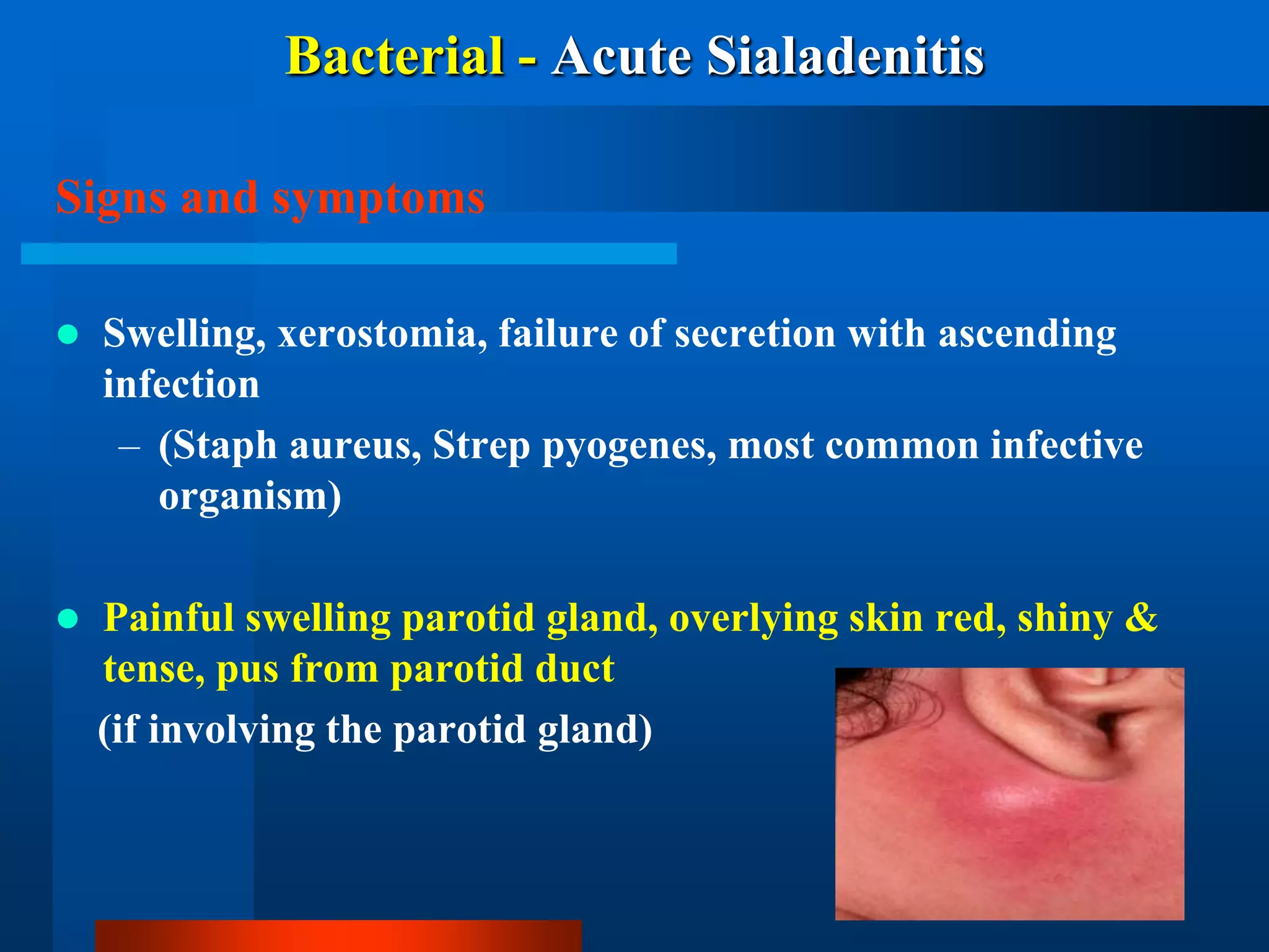 salivary_gland_disease_and_management.ppt