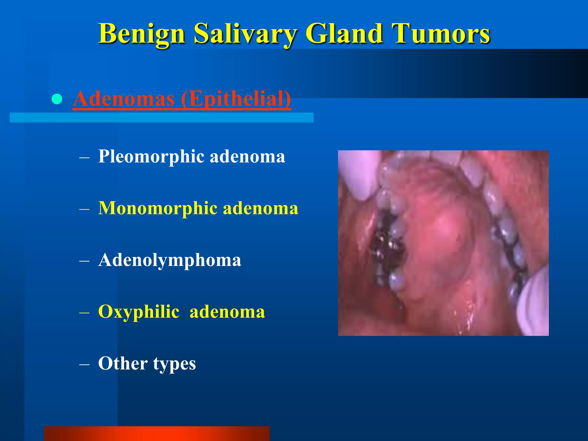 salivary_gland_disease_and_management.ppt