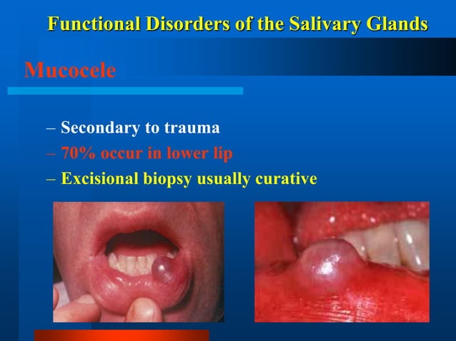 salivary_gland_disease_and_management.ppt