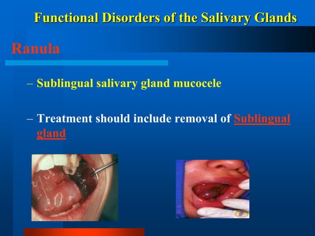 salivary_gland_disease_and_management.ppt