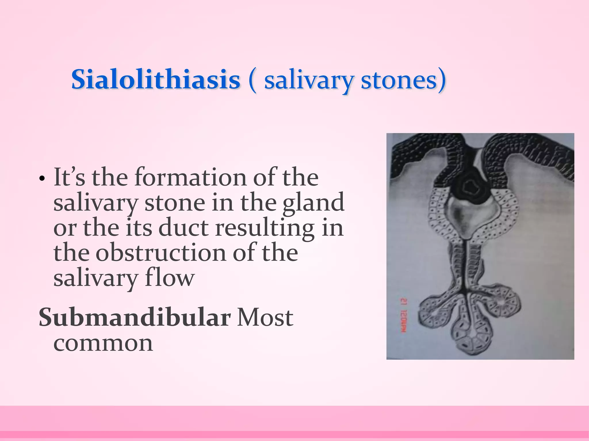 Salivary gland diseases | PPTX