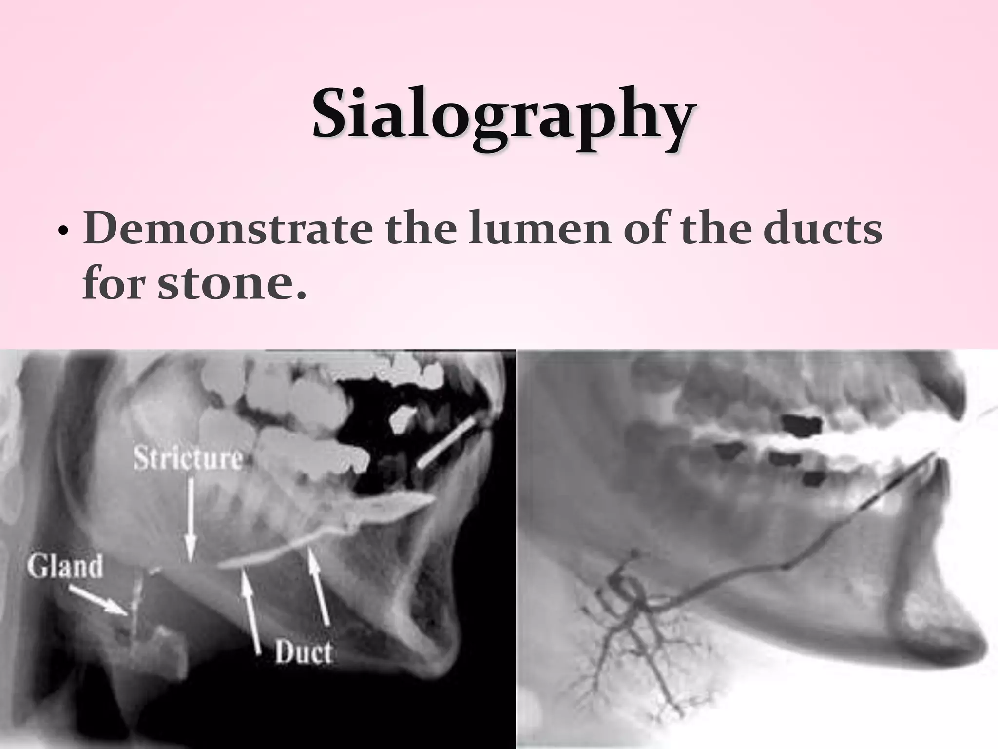 Salivary gland diseases | PPTX