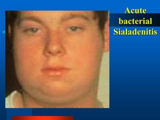 salivary gland diseases..ppt, by professor Dr. Ahmed Al Abbasi | PPT