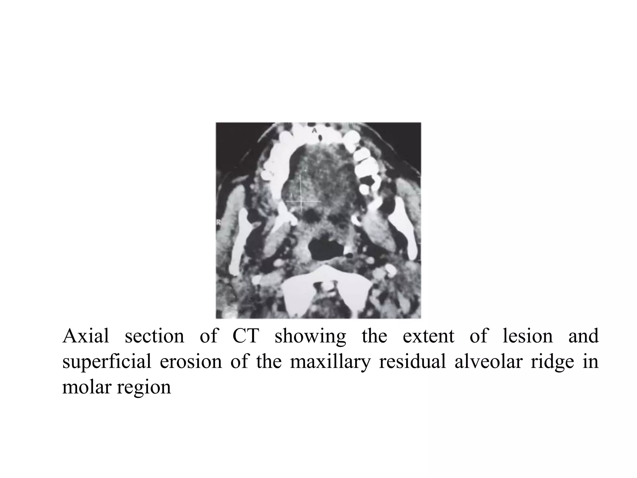 Salivary Gland Disorders | PPT | Free Download