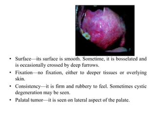 Salivary Gland Disorders | PPTX