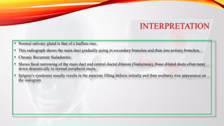 SALIVARY GLAND DISORDERS- 1.pptx- DR PRIYANKA | PPTX
