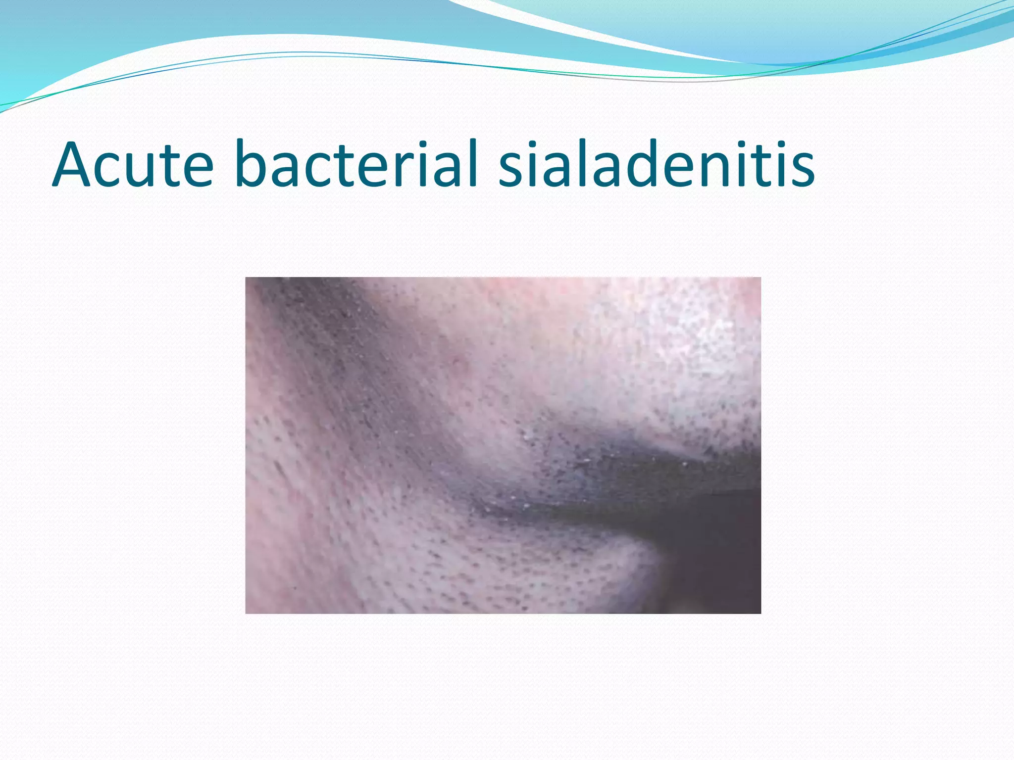 Salivary gland disorders | PPTX