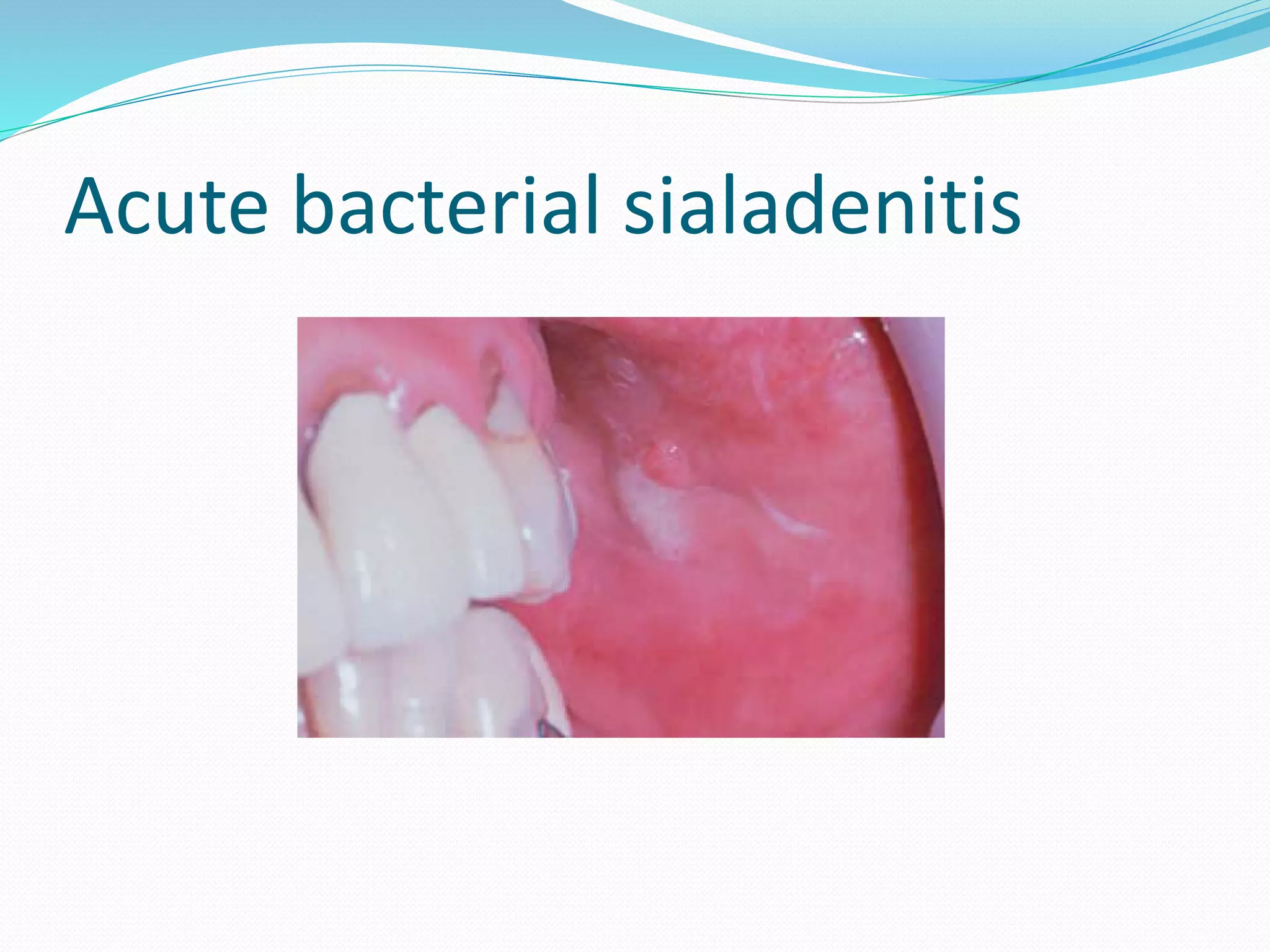 Salivary gland disorders | PPTX
