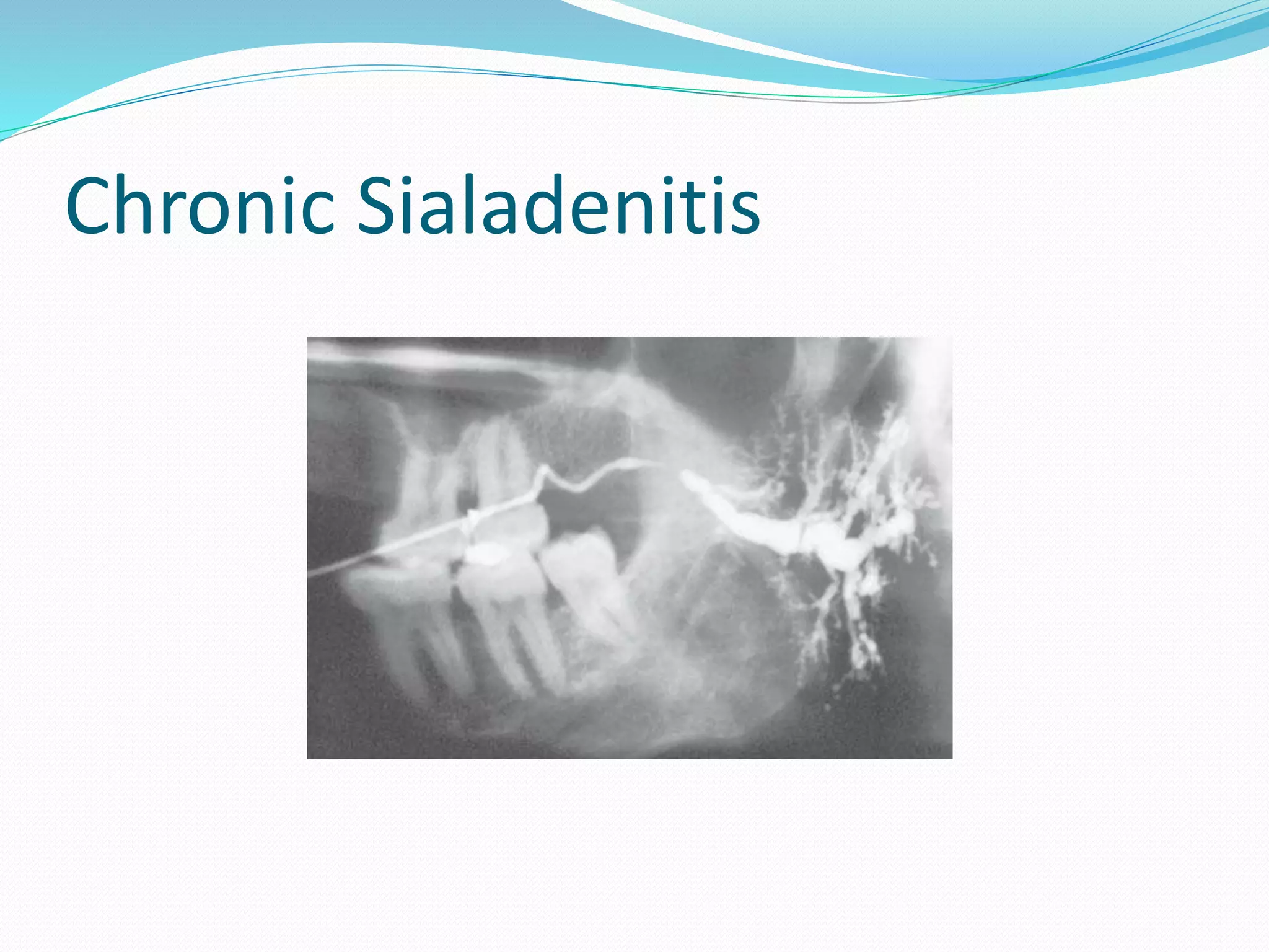 Salivary gland disorders | PPTX
