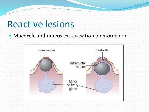 Salivary gland disorders