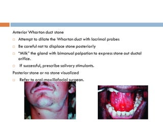 salivary gland disorders.pdf nothing more | PDF