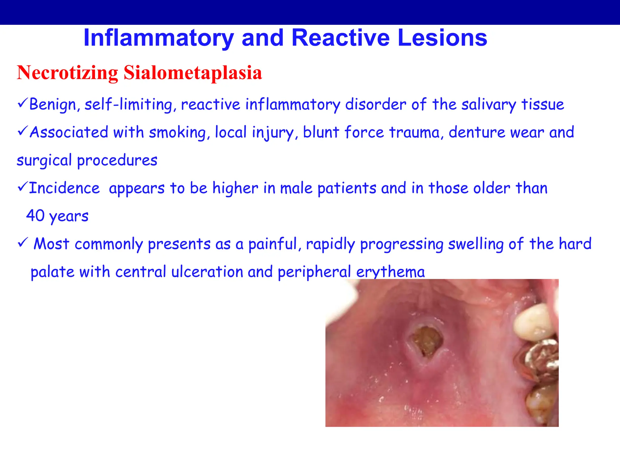 SALIVARY GLAND DISORDERS and their management | PPTX