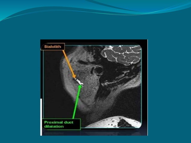 Salivary gland imaging | PPTX | Ear, Nose and Throat Conditions ...