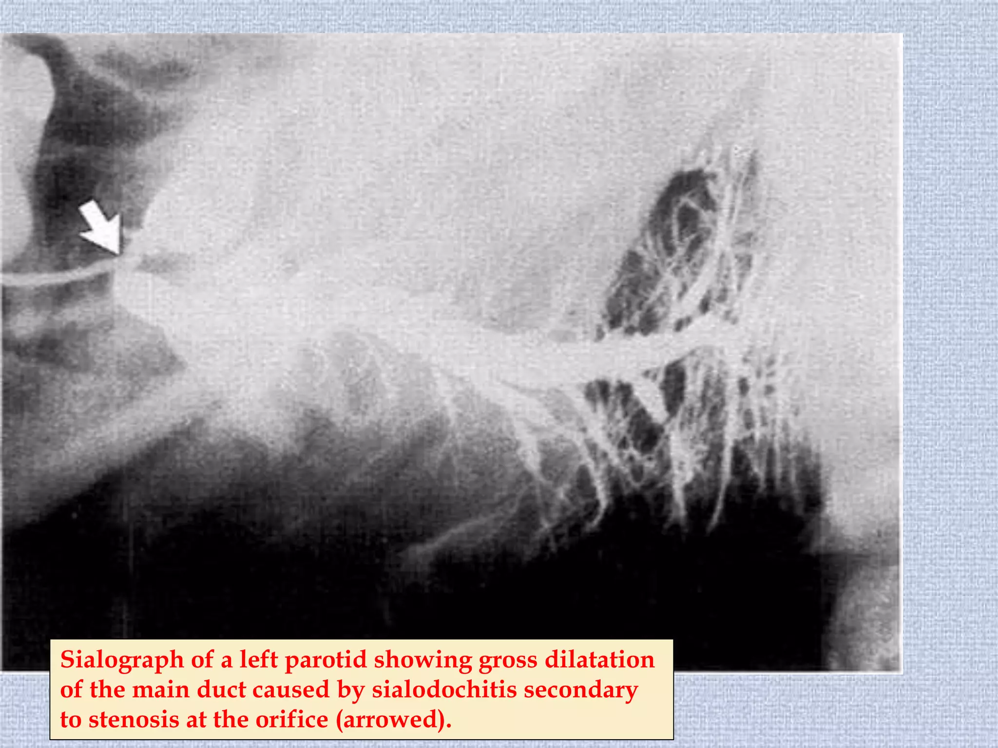 Salivary gland imaging | PPTX